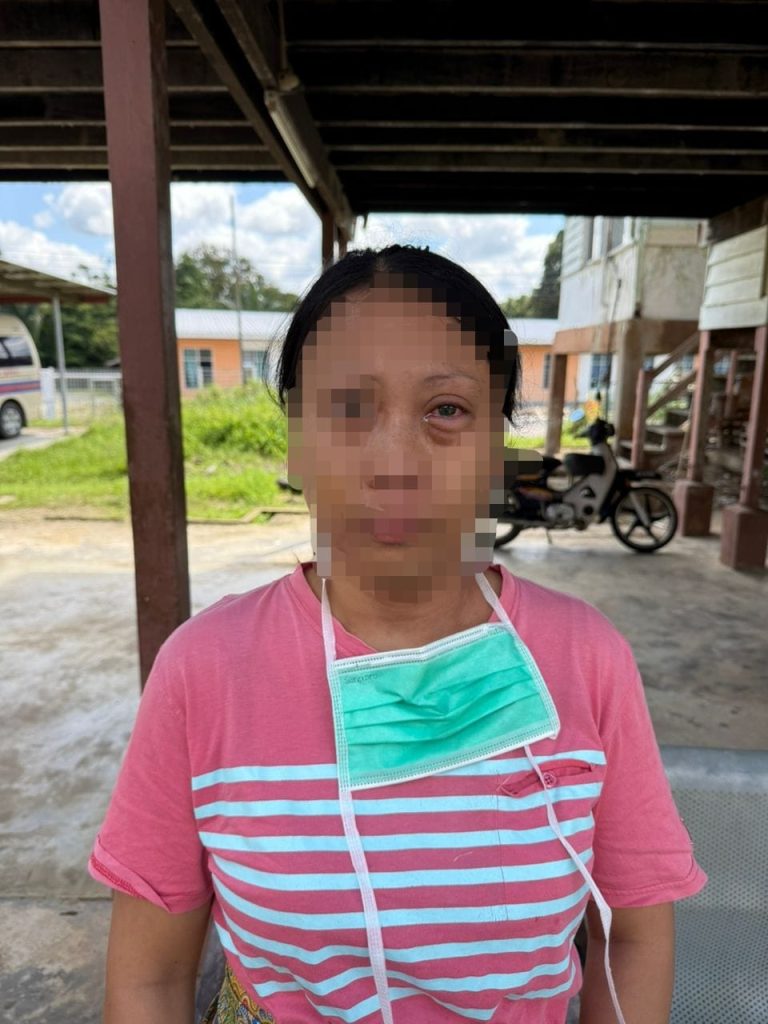 Pembancuh air disimbah cecair dipercayai asid akibat pertengkaran suami ...