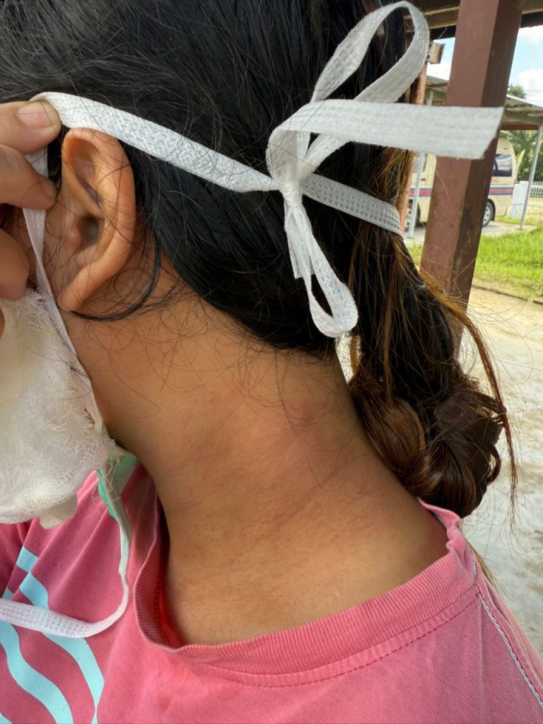 Pembancuh air disimbah cecair dipercayai asid akibat pertengkaran suami ...